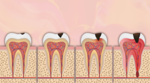 Genetics and Tooth Decay: Are They Related? - Delta Dental of Wyoming Blog